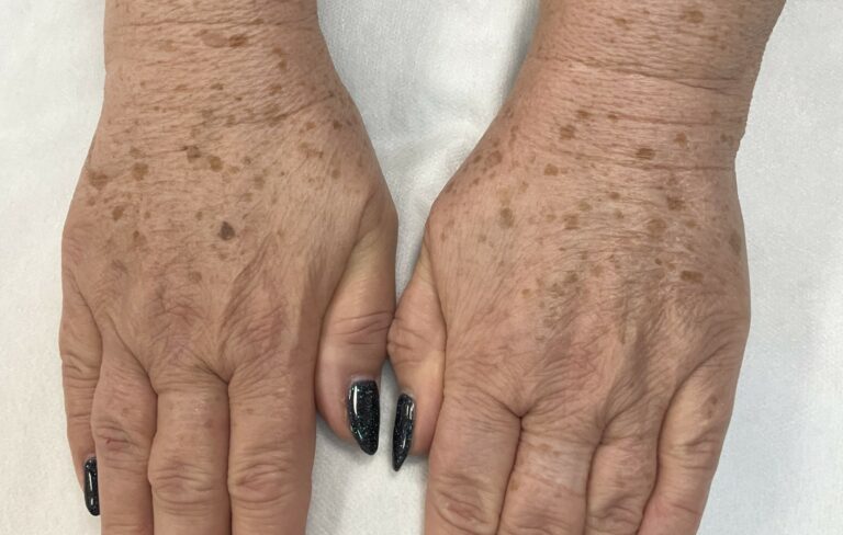 Plamy starcze - jak wyglądają, jak je zwalczyć, co je powoduje?